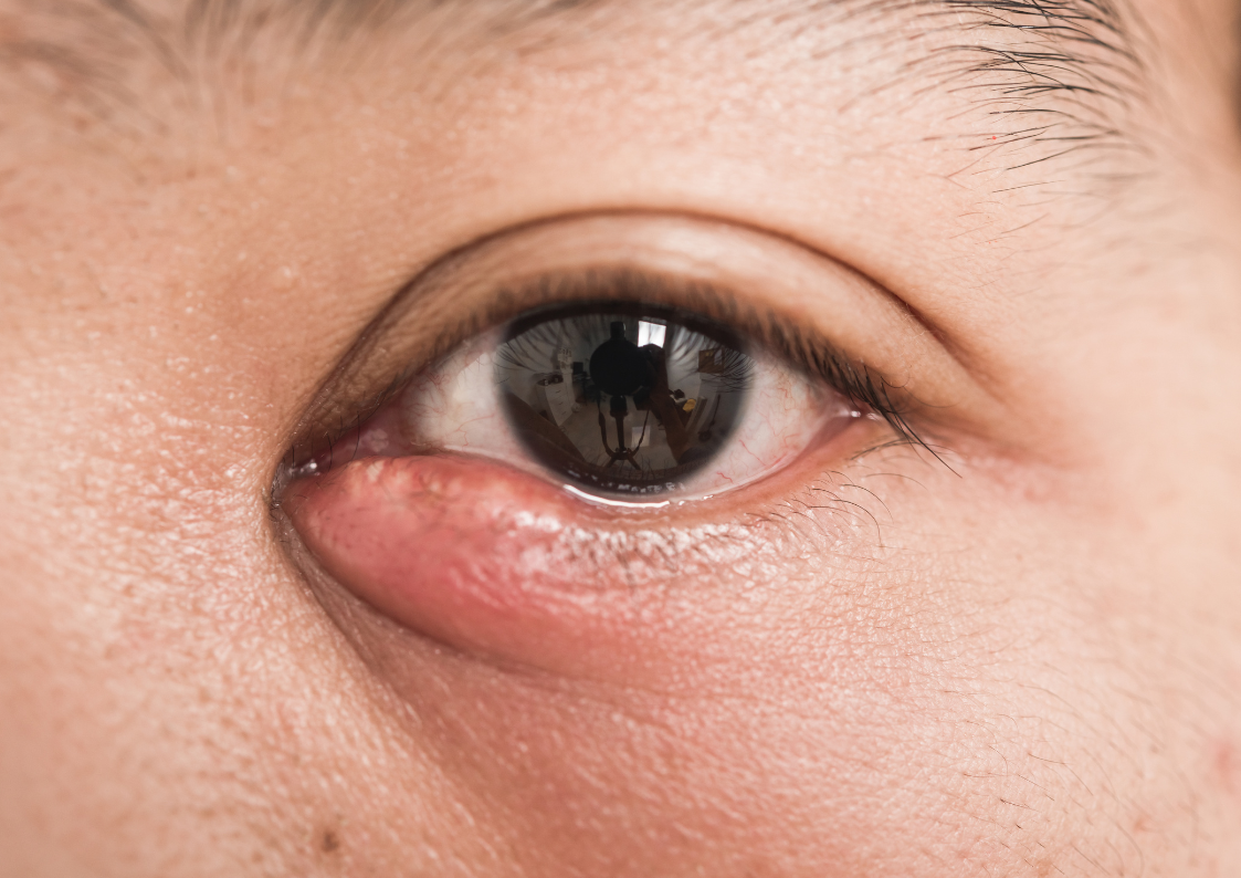 Nature's Eye: The Ultimate Guide to Natural Remedies for Stye Relief